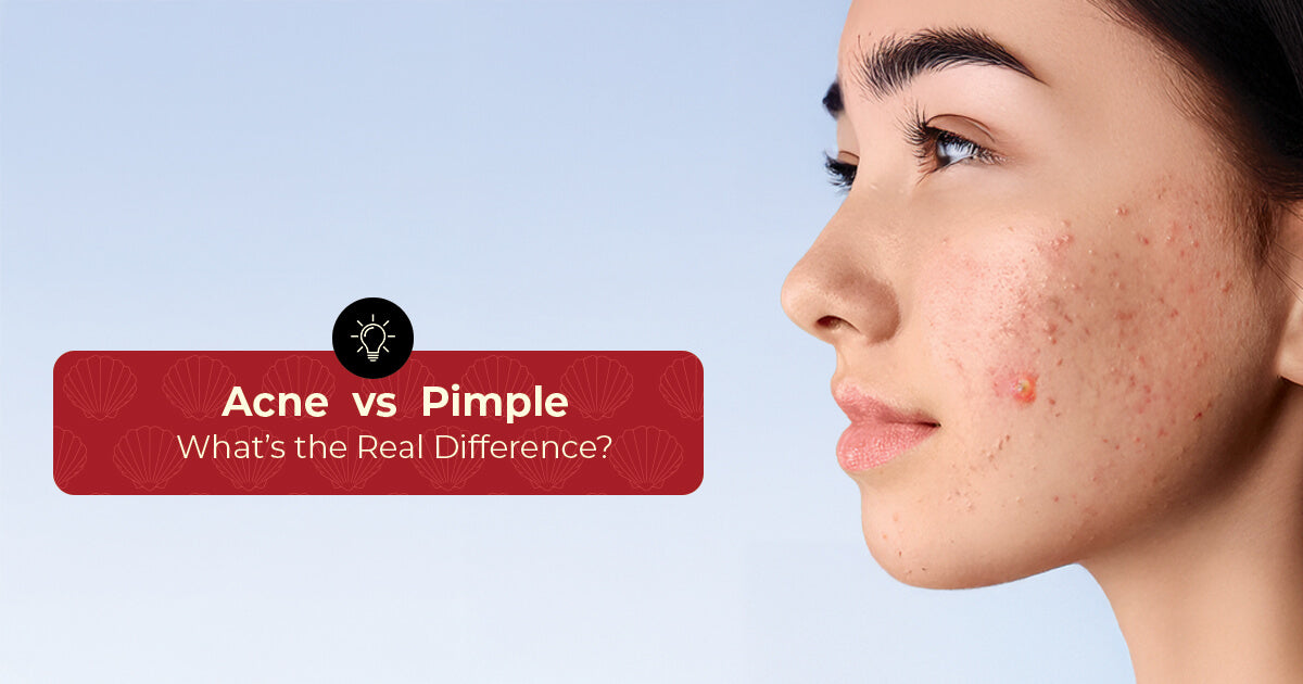 Acne vs. Pimple: What’s the Real Difference?